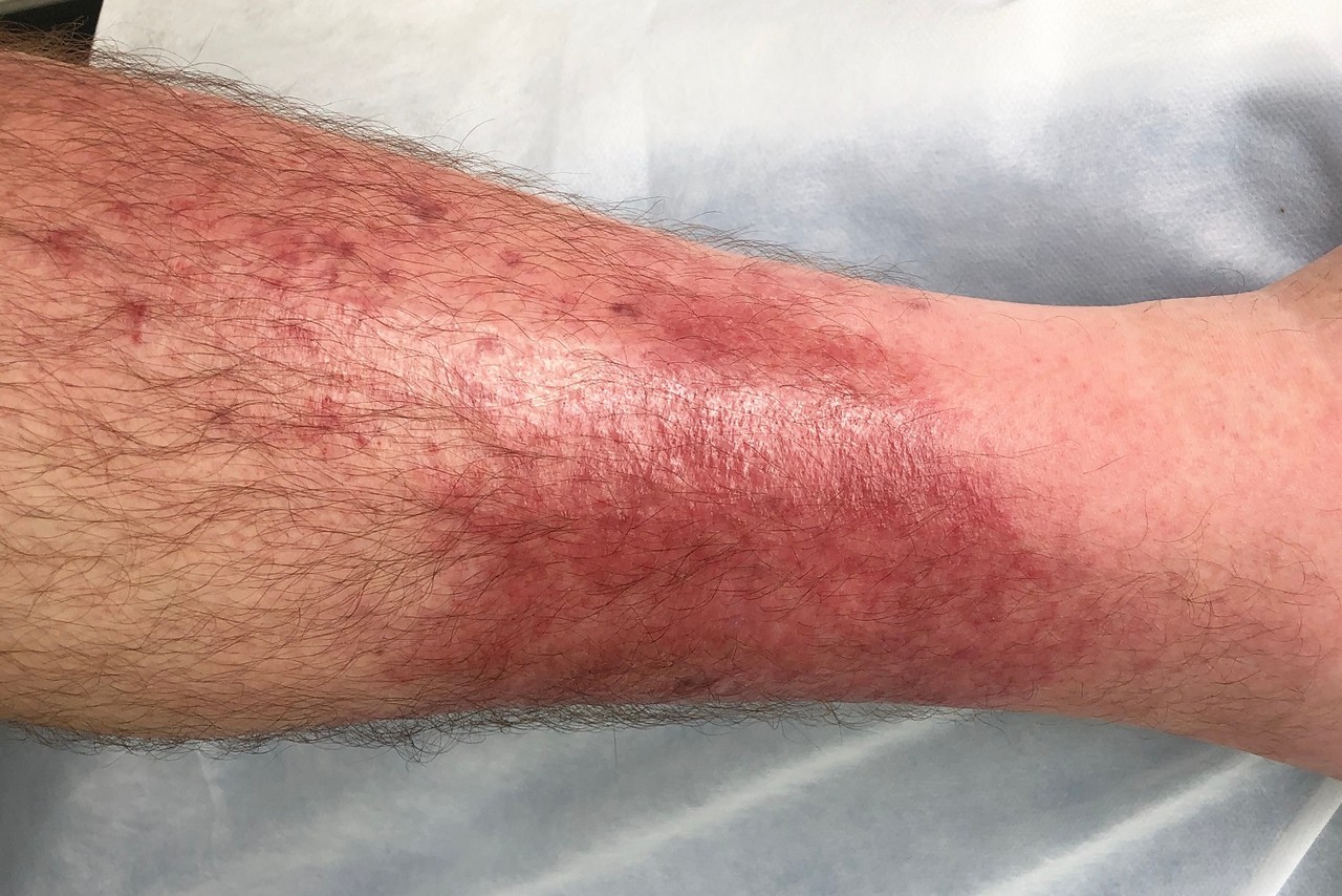 Čo je to flegmóna? Zistite, čo vyvoláva flegmonózny zápal kože ...