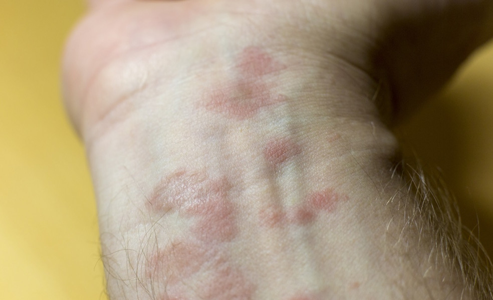 Červené suché fľaky na tele – o aký zdravotný problém môže ísť ...